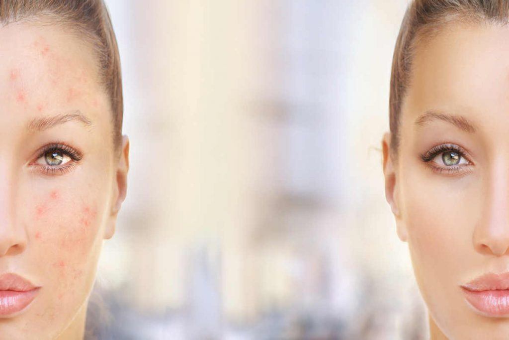 Traitement de l'acné chez l'adulte - Institut MySkin Genève