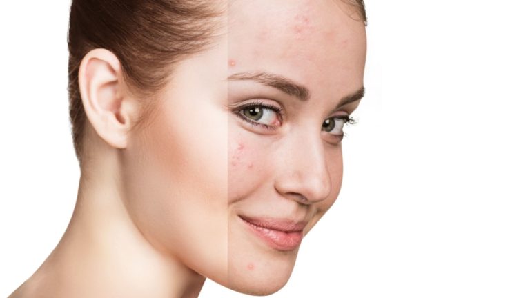 Peaux Sensibles à Tendance Acnéique Institut My Skin Genève